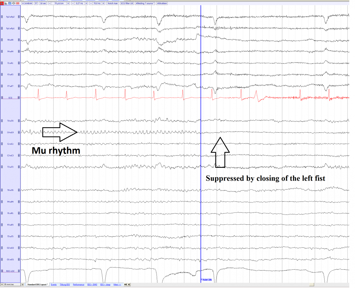 Mu rhythm - EEGpedia